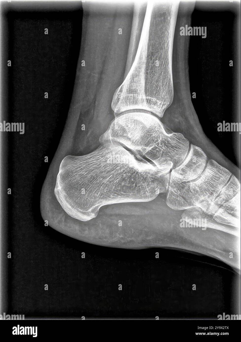 X-ray image of the ankle showing a fracture to lateral malleolus ...