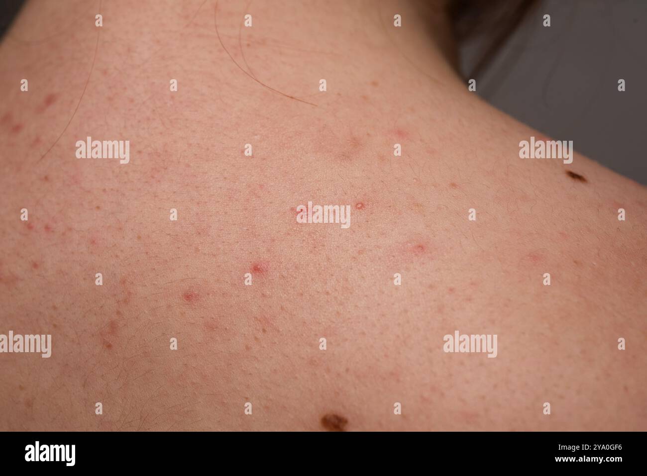 Pimple closeup. Skin texture. Closeup acne skin. Treatment for skin ...