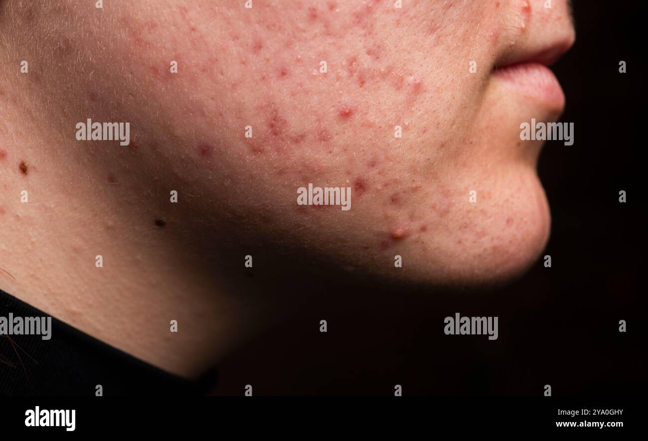 Skin treatment. Acne vulgaris, black spots and pimples. Girl with bad ...