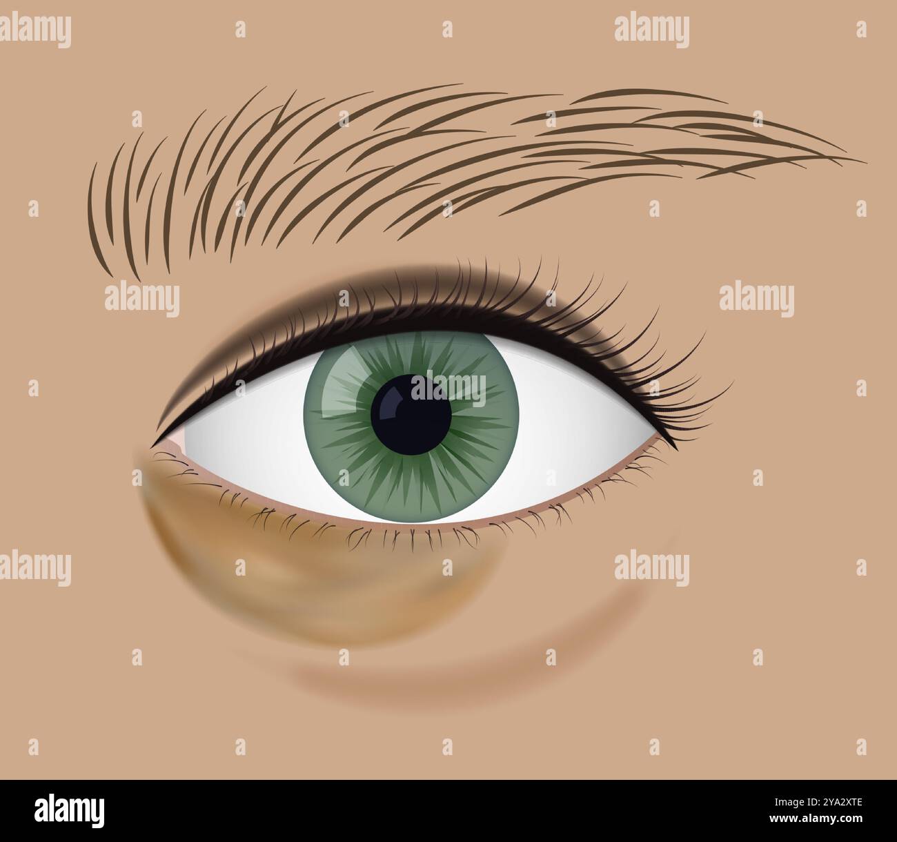 Bruise hematoma under eye close hi-res stock photography and images - Alamy