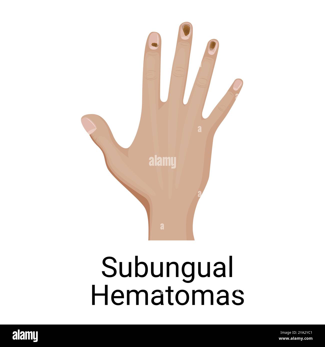 Subungual hematoma, blood underneath a fingernail Stock Vector Image ...