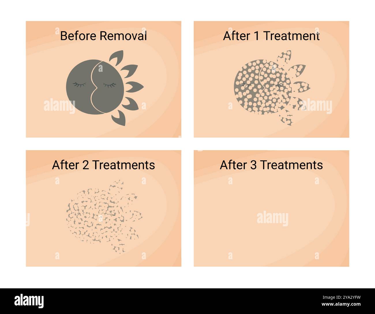 Tattoo laser removal Cut Out Stock Images & Pictures - Alamy