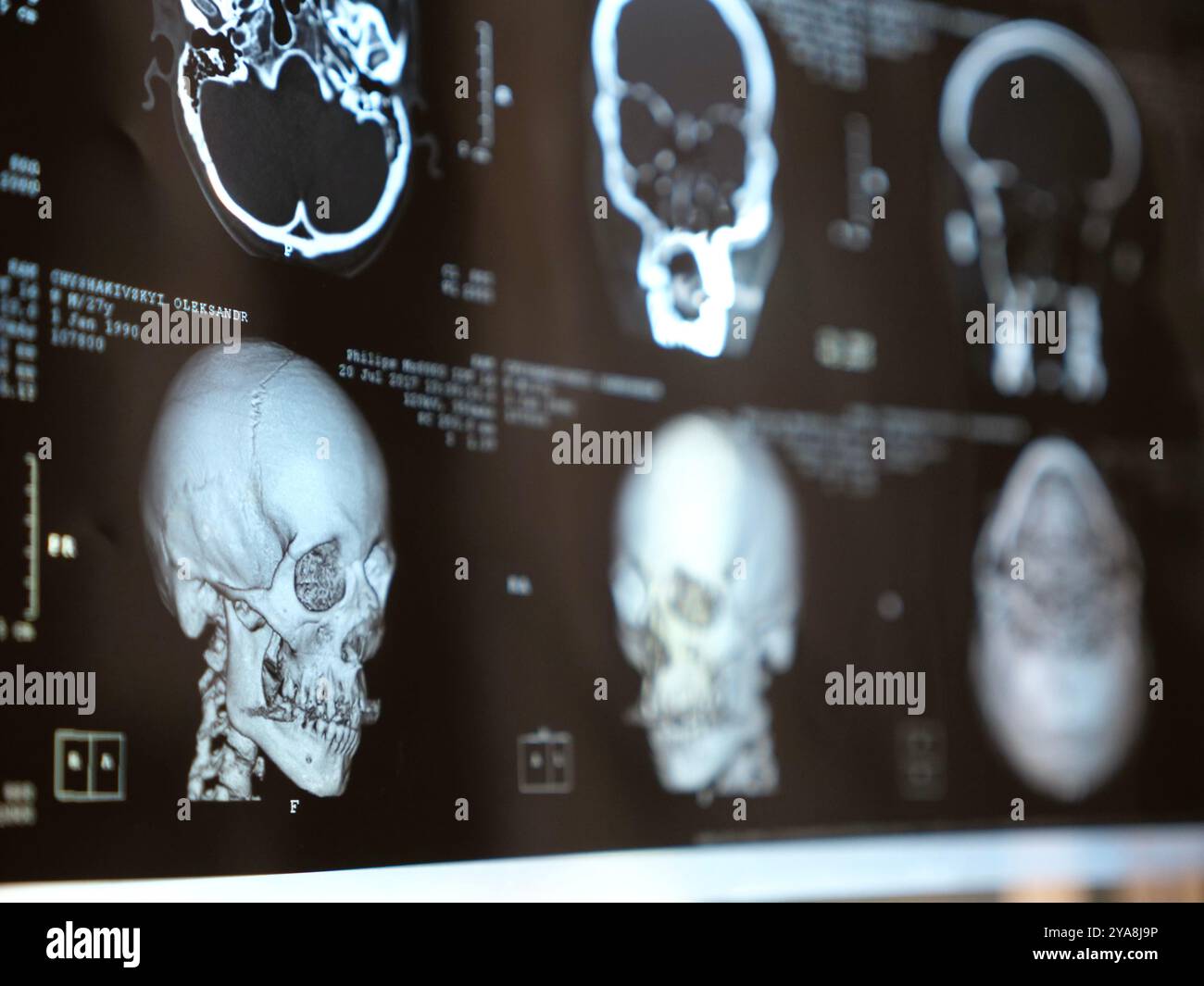 MRI of the human brain of a patient with multiple sclerosis of the ...