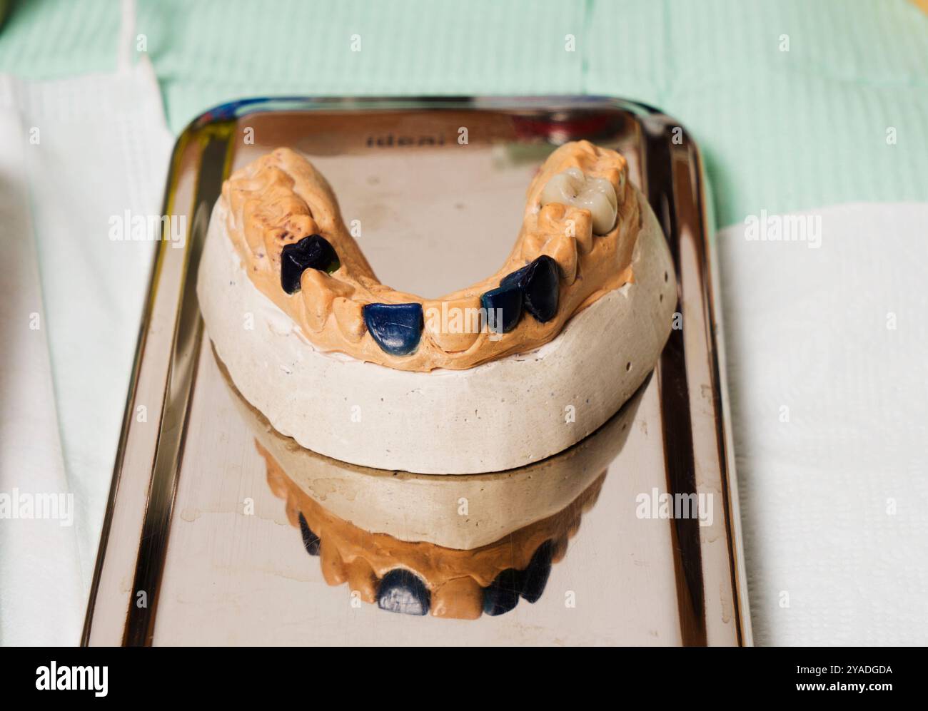 A partial denture mounted on a plaster study model and placed on a ...