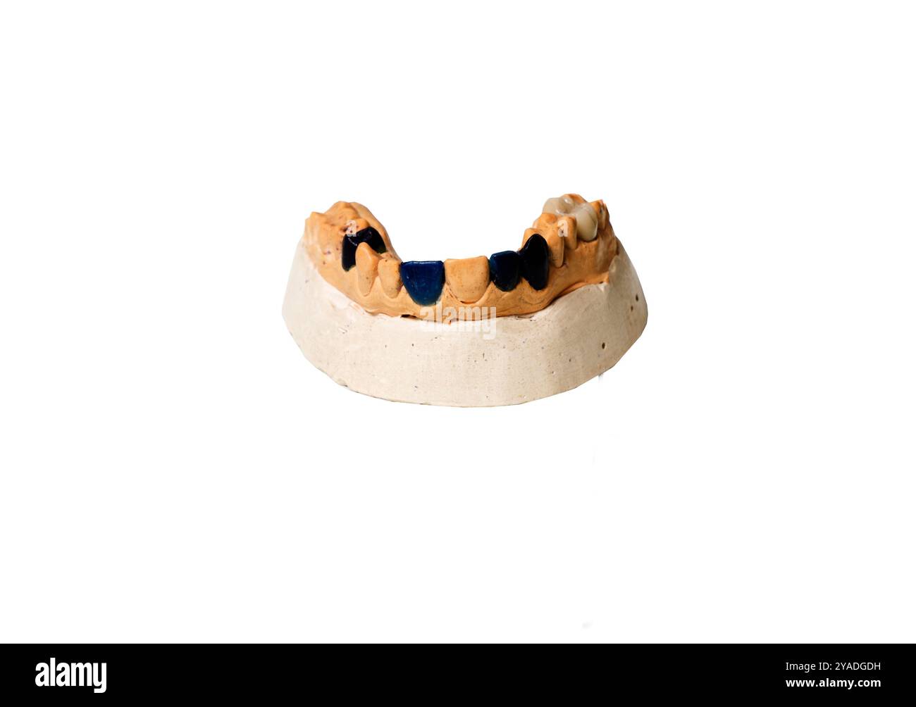 A partial denture mounted on a plaster study model and placed on a ...