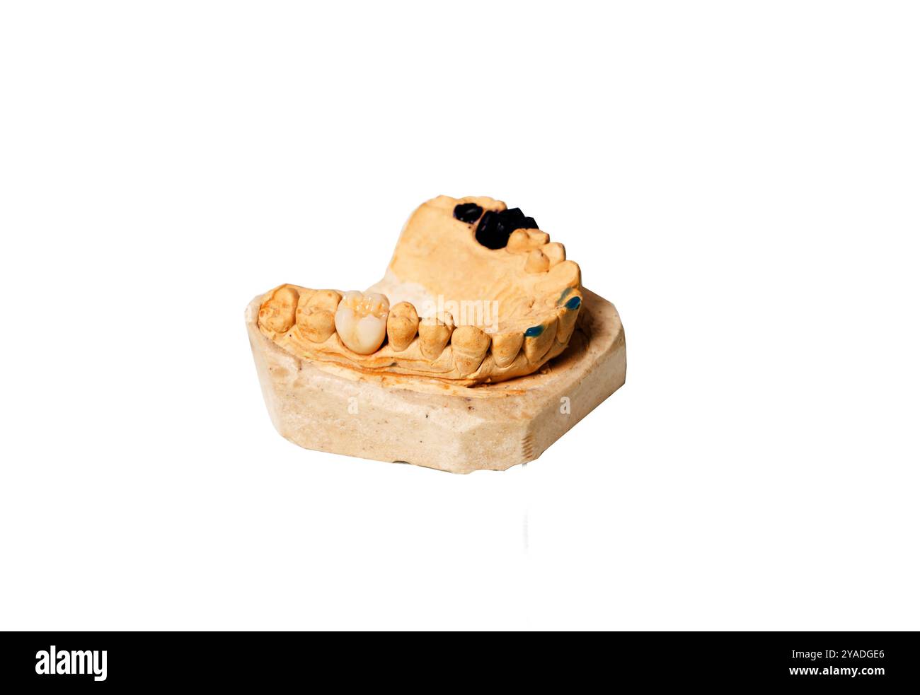 A partial denture mounted on a plaster study model and placed on a ...