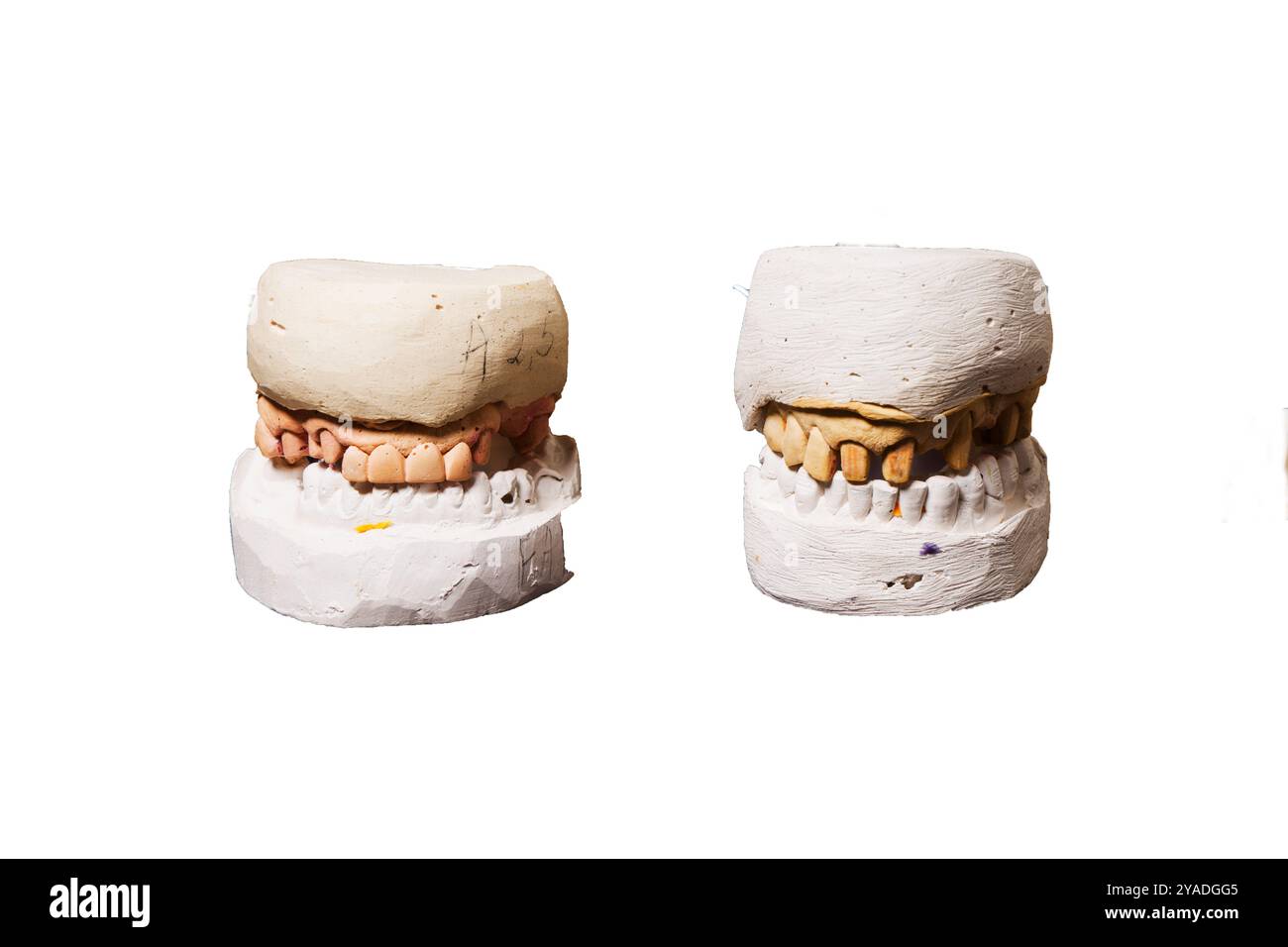 A partial denture mounted on a plaster study model and placed on a white background Stock Photo ...