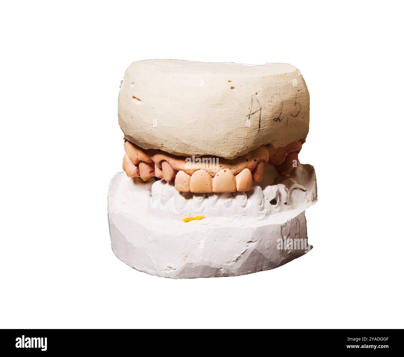A partial denture mounted on a plaster study model and placed on a ...