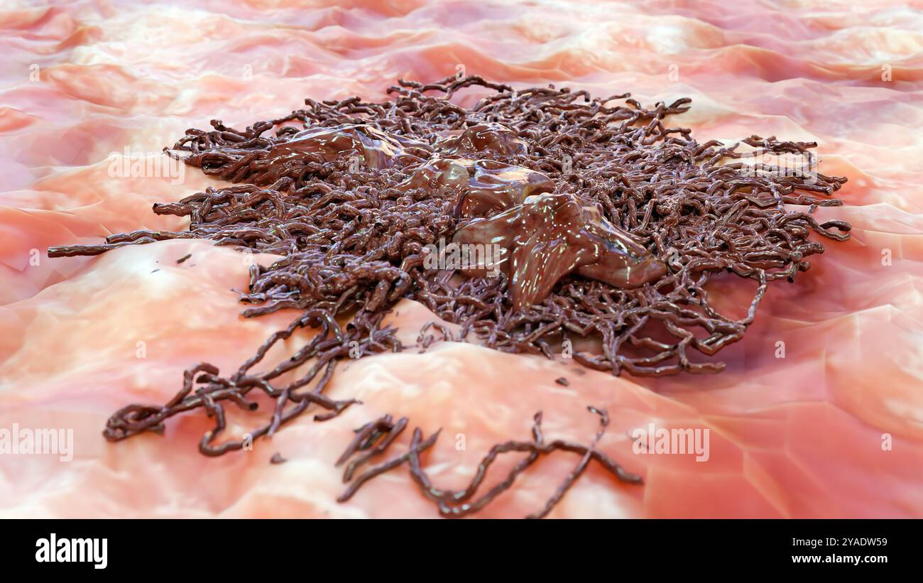 Cancer cell growth uncontrollably over tissue, Tumor infection cells ...