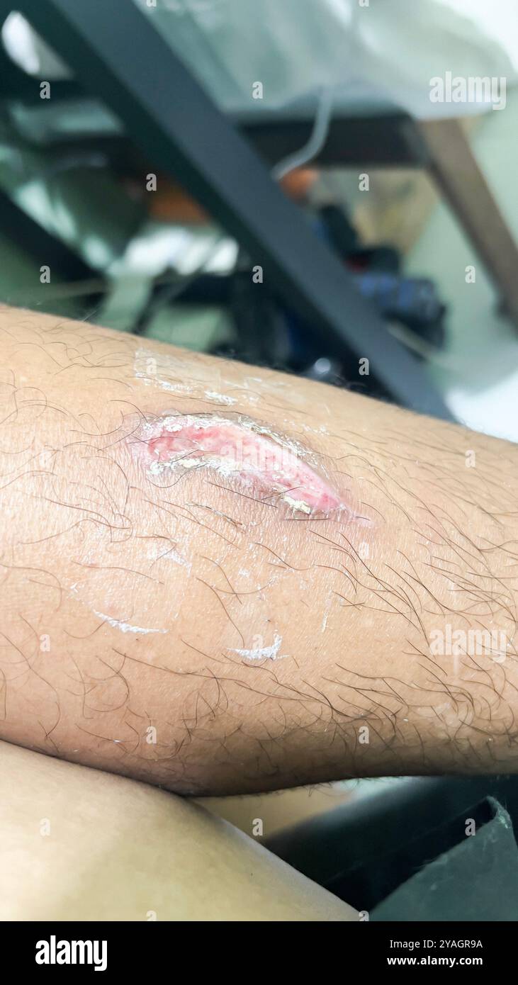 Children injury. Deep scratches on the skin of the children's legs ...