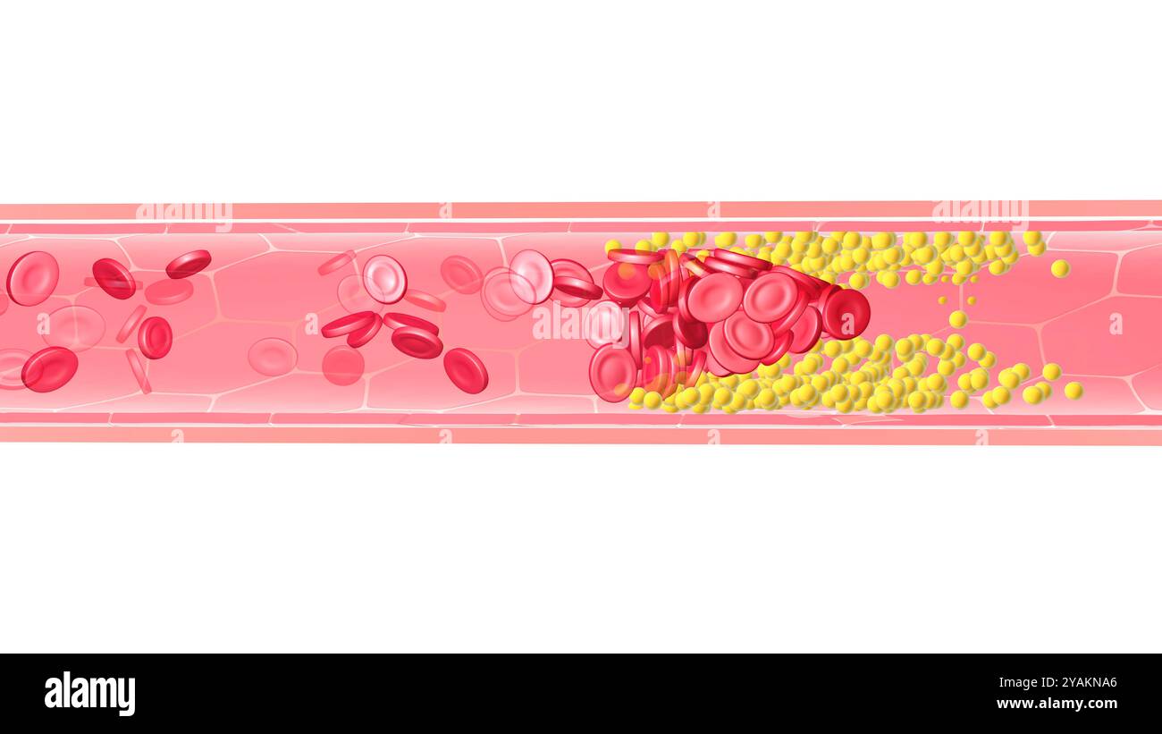 Anatomical 3D illustration of the interior of an artery clogged by fat ...