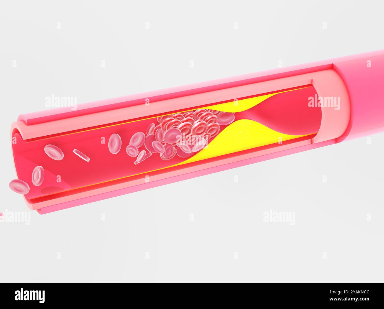 Anatomical 3D illustration of the interior of an artery obstructed by ...