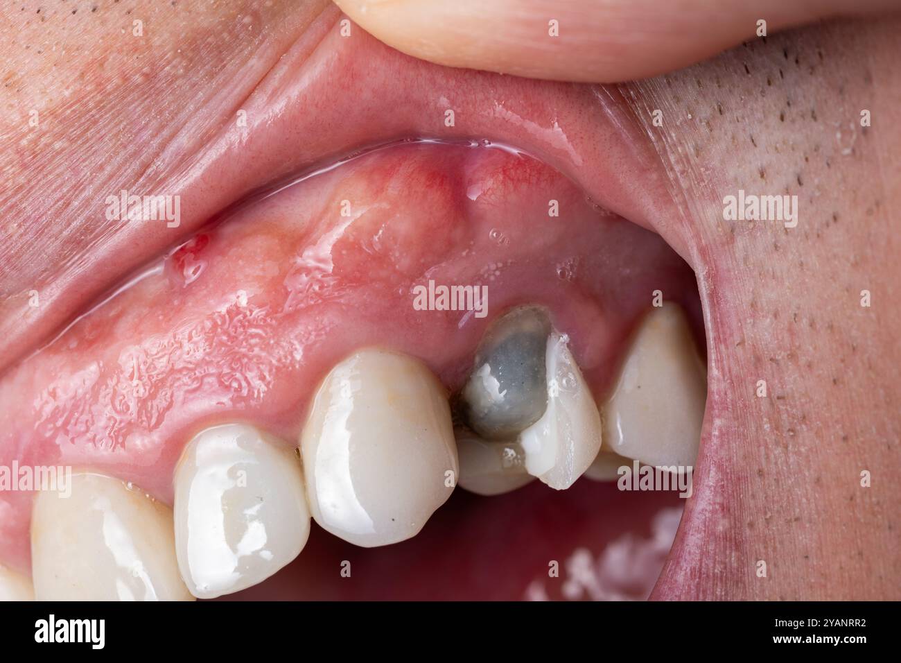 Caucasian male open mouth and teeth with broken upper premolar tooth ...