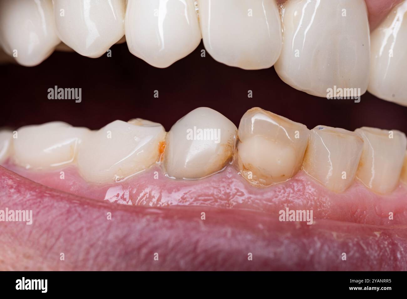 Caucasian man open mouth with teeth and gums, macro close up shot Stock ...