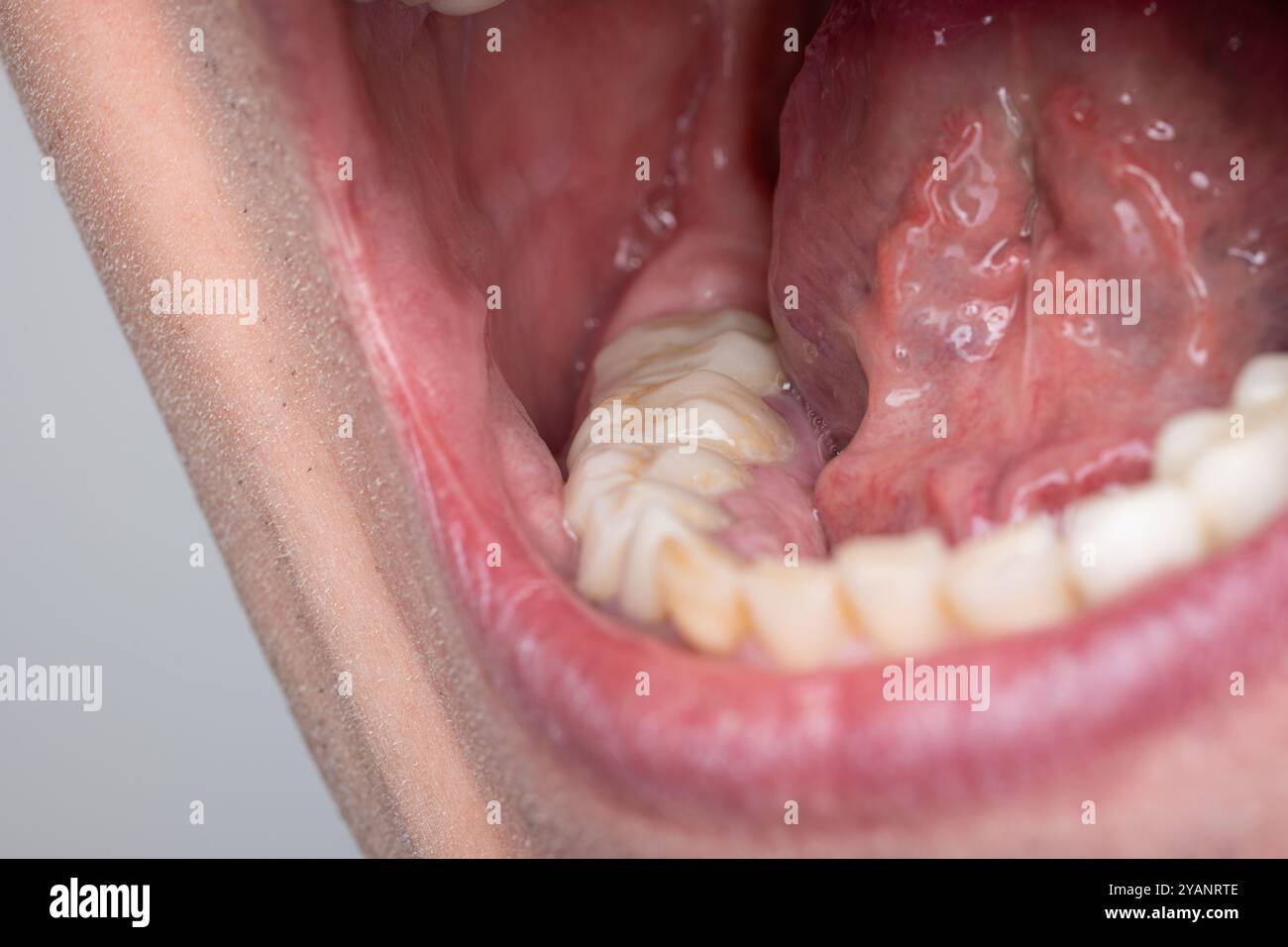 Caucasian man oral cavity, wide open mouth and raised tongue, molars ...