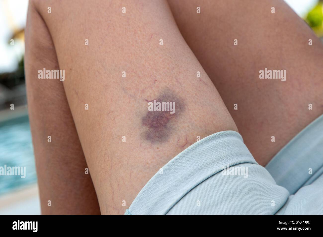 Bruises hi-res stock photography and images - Alamy
