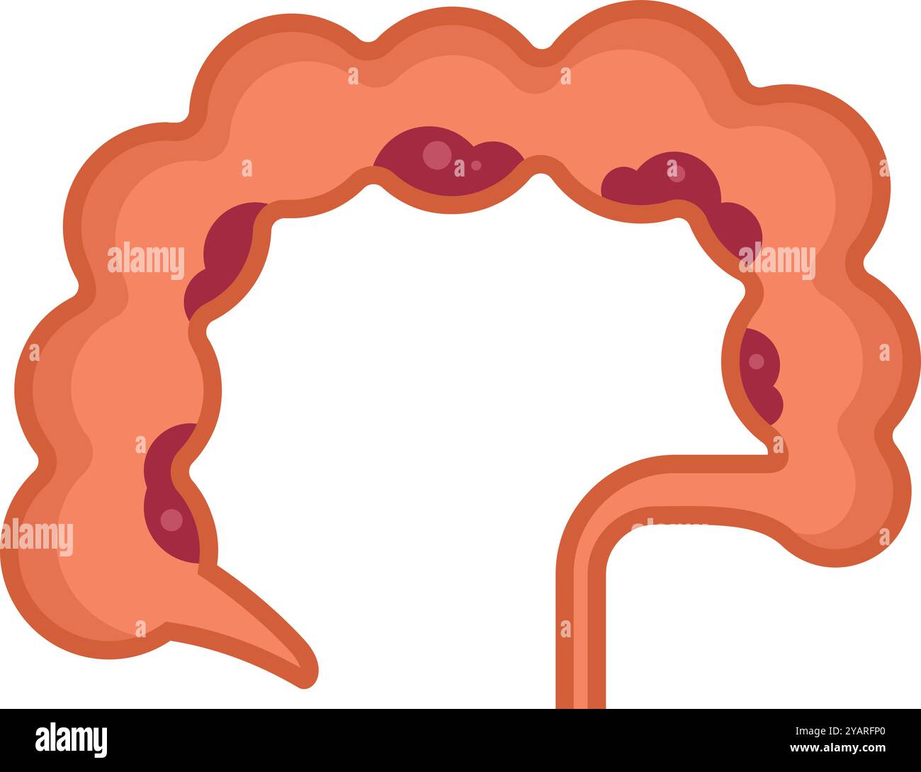 Illustration of a large intestine with diverticulitis, a digestive ...
