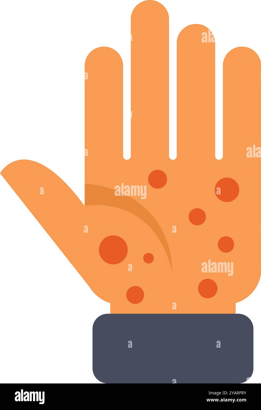 Human hand with a monkeypox rash, depicting the symptoms of the ...