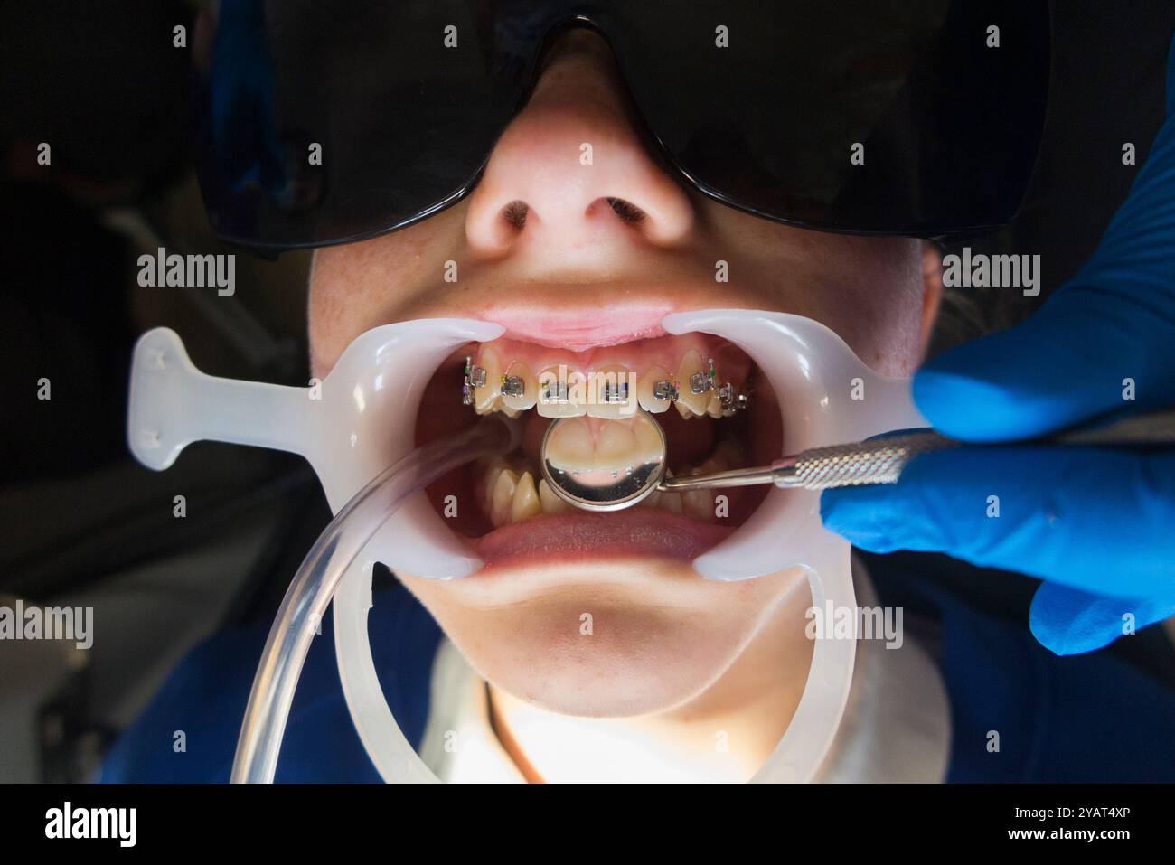 Young girl aged 12 years gets NHS dental braces, brace, fitted to her ...