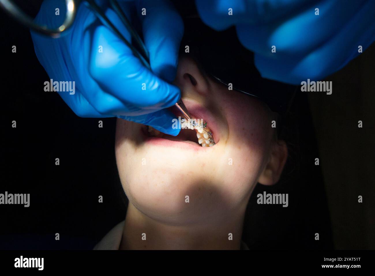 Young girl aged 12 years gets NHS brace, braces, fitted to her ...