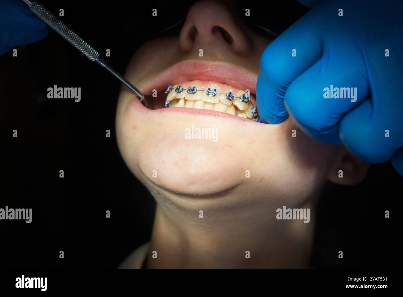 Young girl aged 12 years gets NHS brace, braces, fitted to her ...