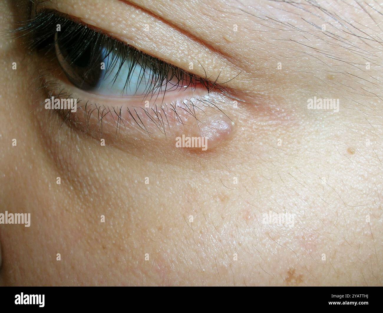 Hidrocystoma. This condition is an adenoma of the sweat glands, often ...