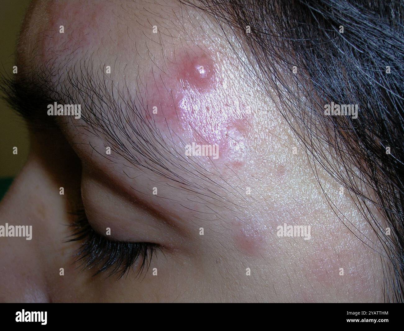 Lesions on the forehead of a 33 year old Bengali female patient with ...