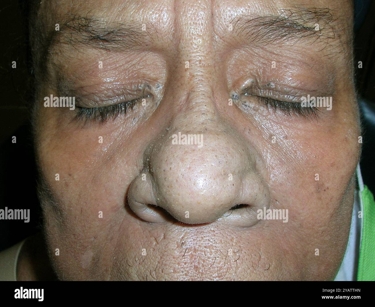 Face of a Hispanic female patient with mixed connective tissue disease ...
