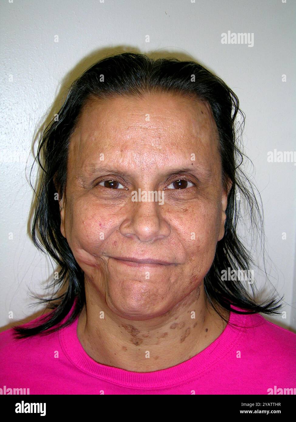 Basal cell nevus syndrome Stock Photo - Alamy