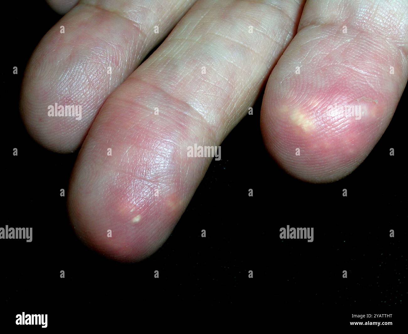 Calcinosis cutis on the fingers of a Hispanic female patient. This is ...