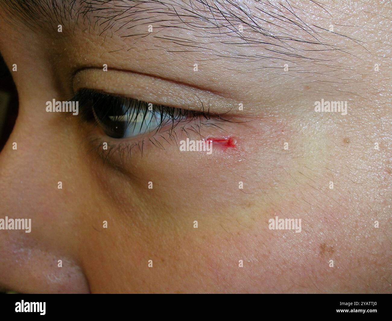 Hidrocystoma after excision. This condition is an adenoma of the sweat ...