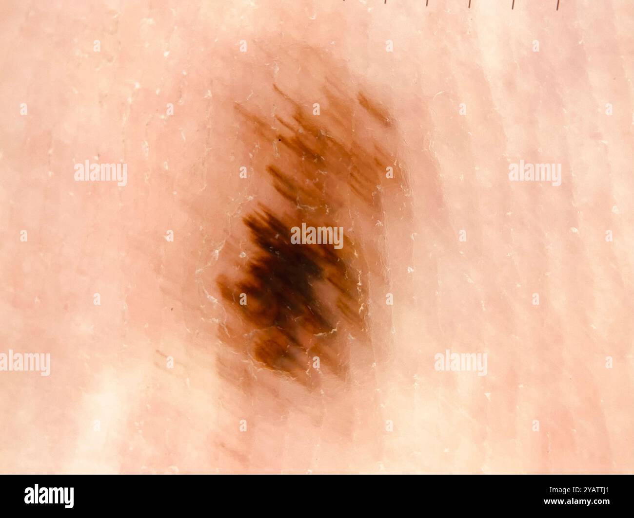Dermatoscope image of a mole on the sole of the foot of an African ...