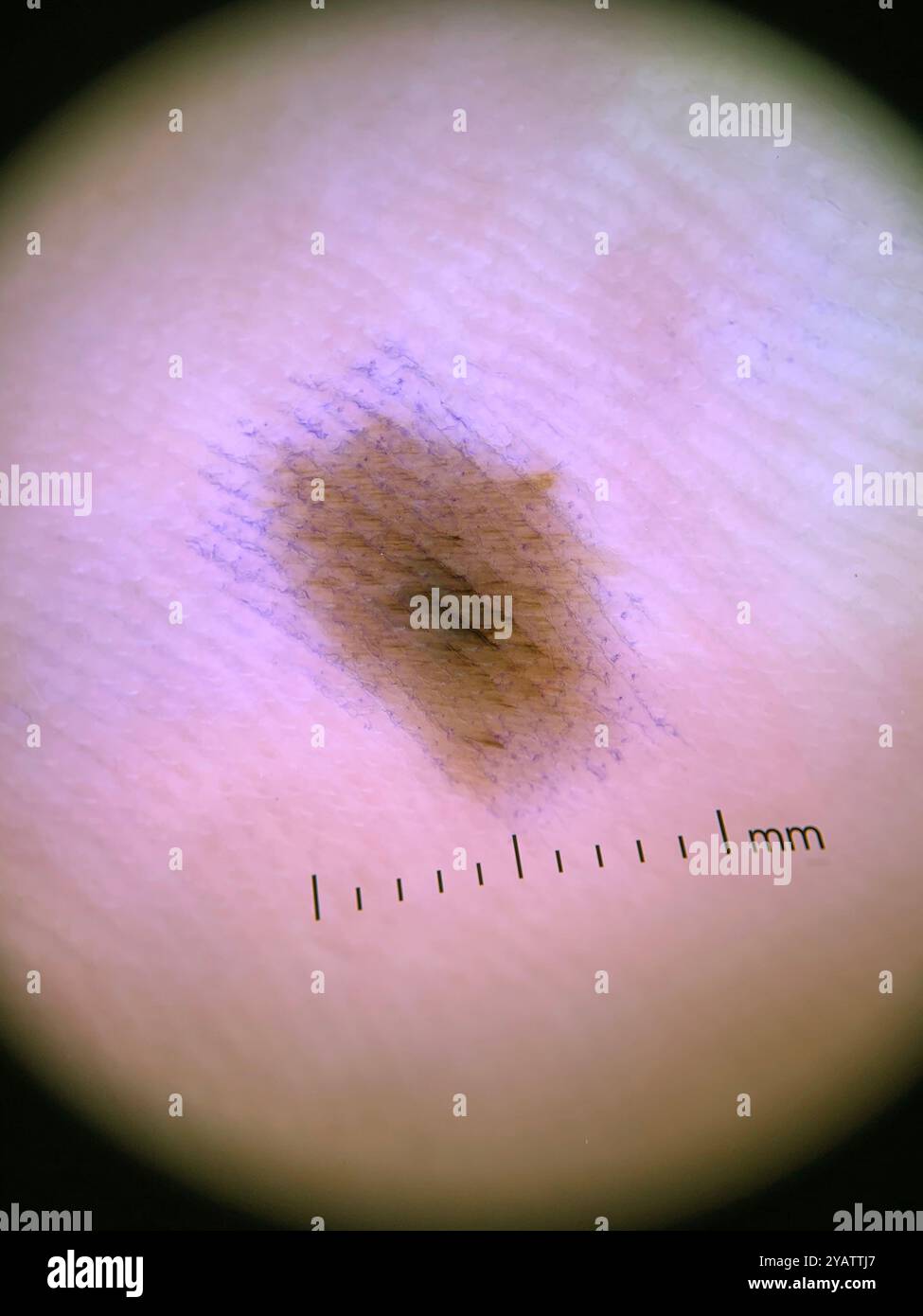 Dermatoscope image of a mole on the sole of the foot of a 30 year old ...