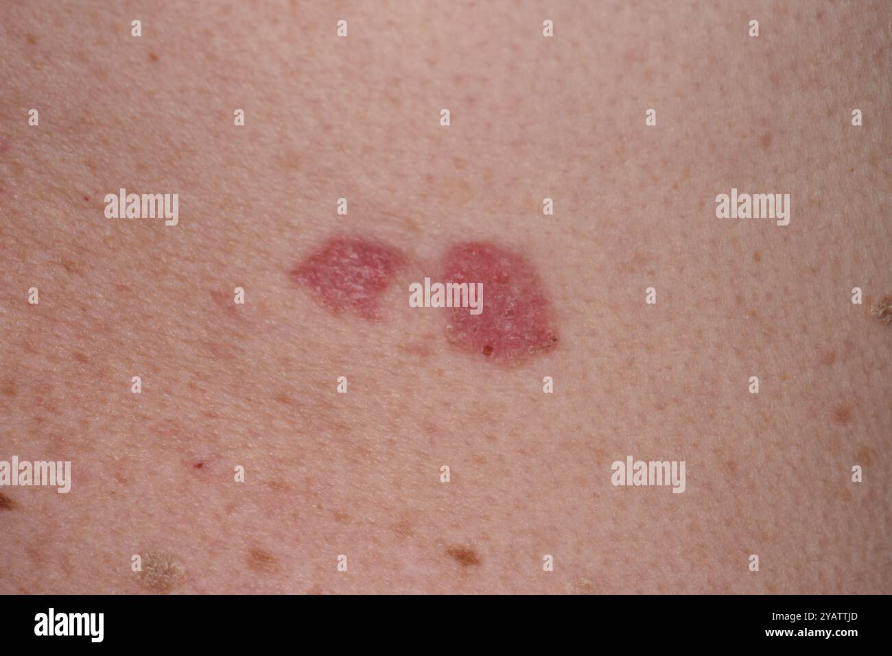 Basal cell carcinoma (BCC), or rodent ulcer, on a caucasian male ...