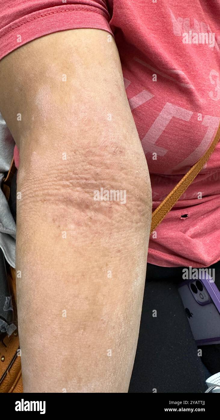 Atopic dermatitis on a Hispanic female patient's arm. Atopic dermatitis ...