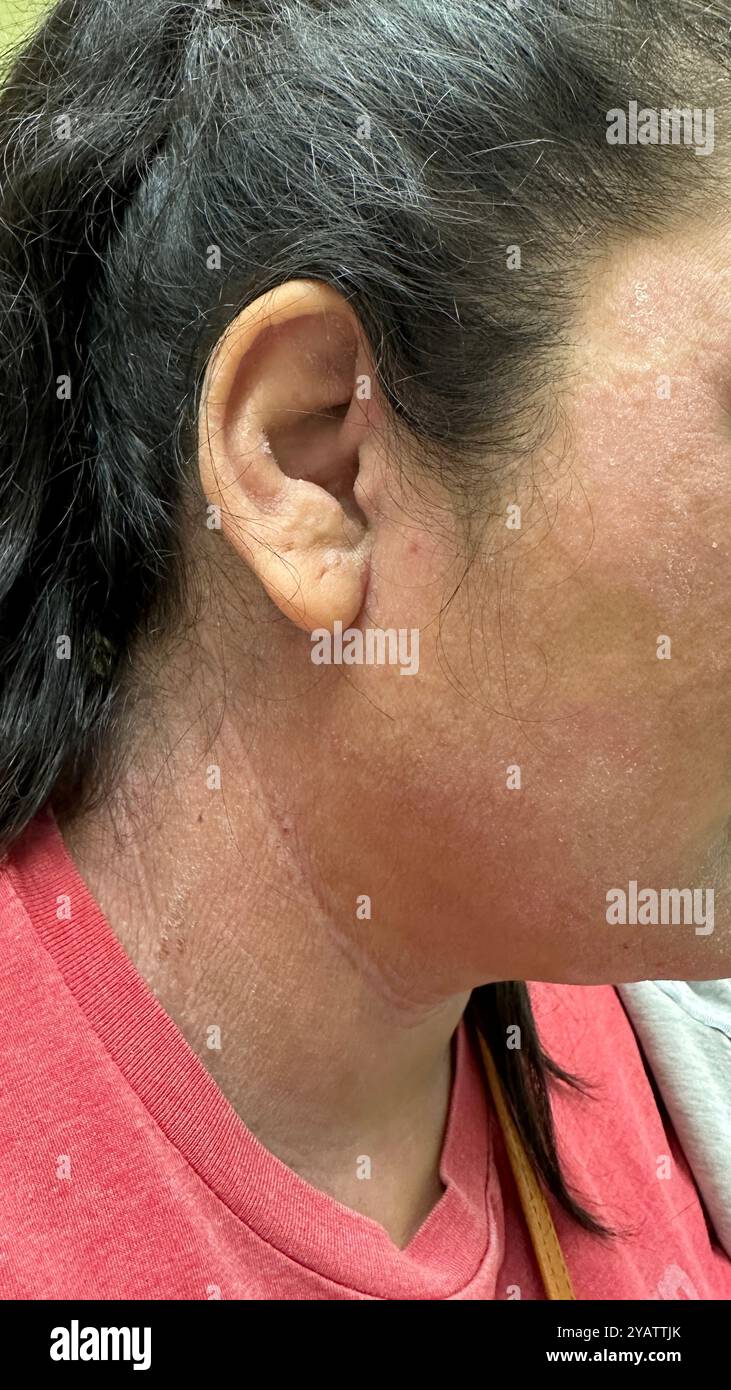 Atopic dermatitis on a Hispanic female patient's face and neck. Atopic ...