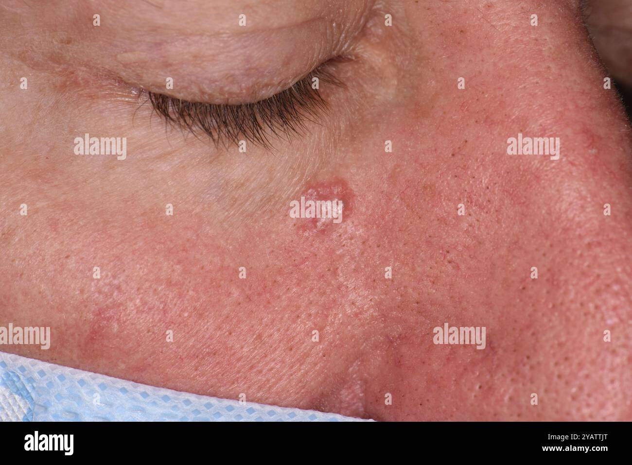 Basal cell carcinoma (BCC), or rodent ulcer, on a caucasian male ...