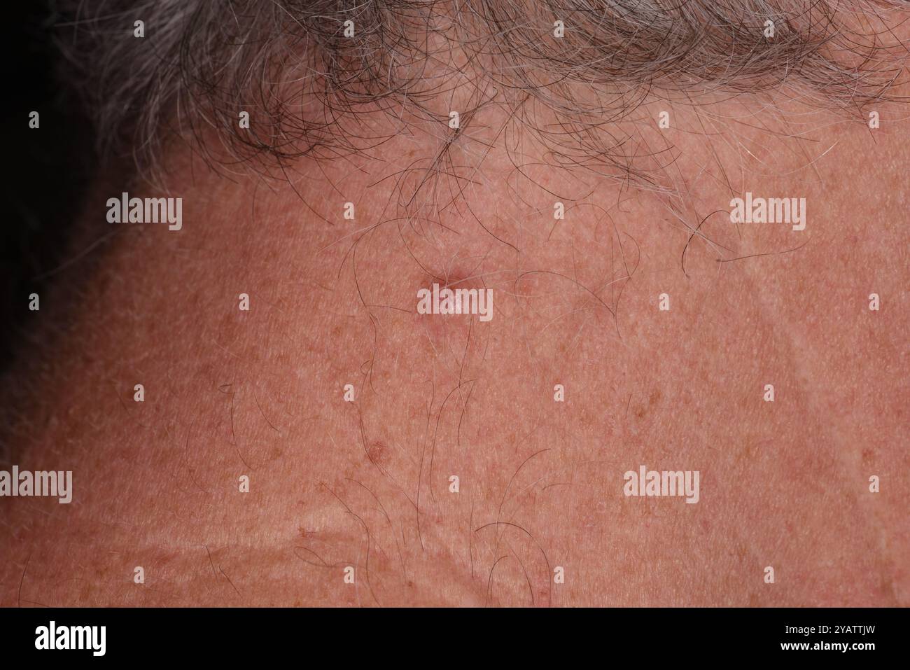 Basal cell carcinoma (BCC), or rodent ulcer, on a caucasian male ...