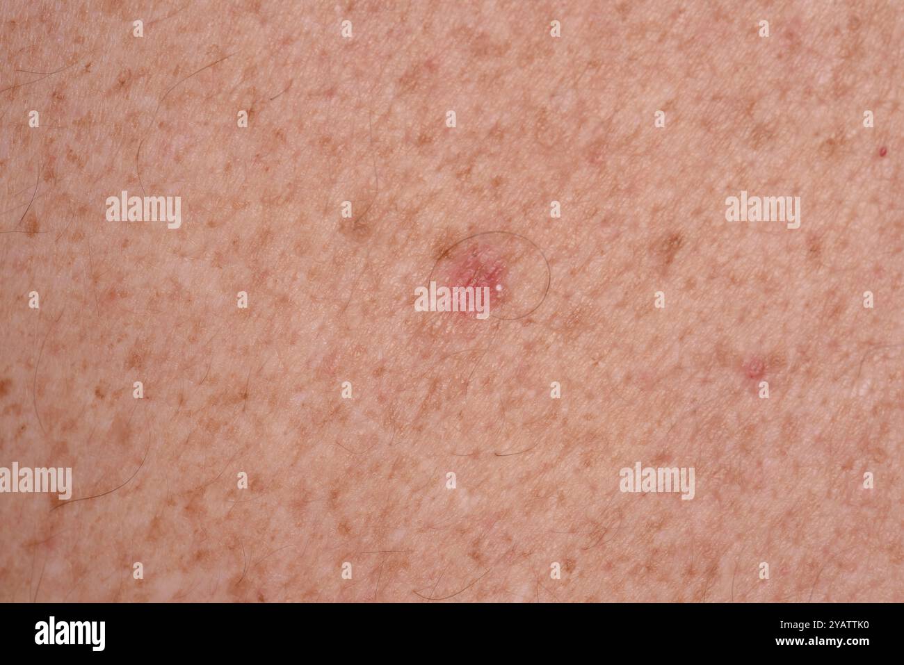 Basal cell carcinoma (BCC), or rodent ulcer, on a caucasian male ...