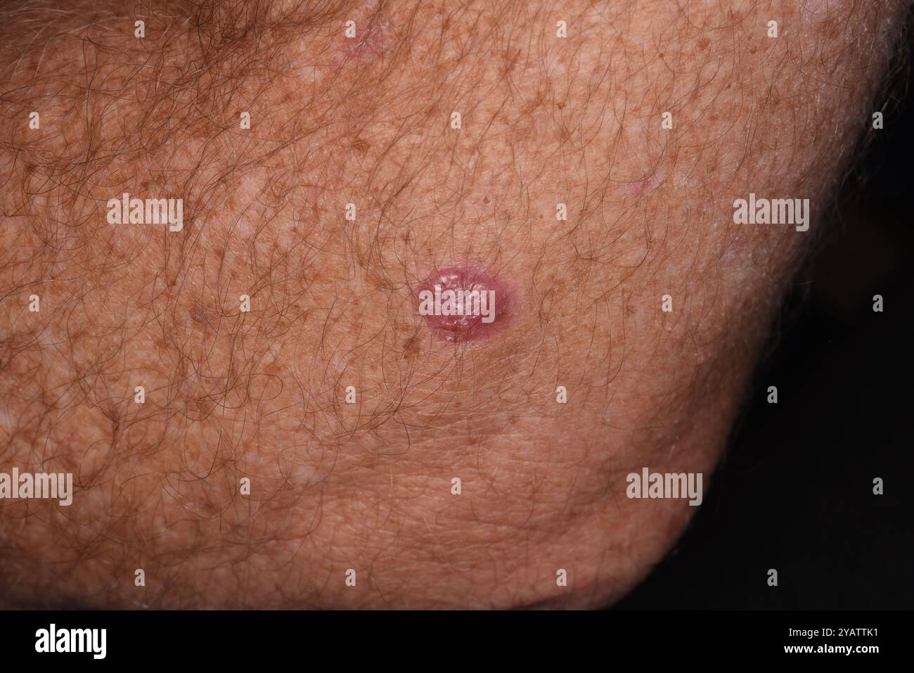 Basal cell carcinoma (BCC), or rodent ulcer, on a caucasian male ...