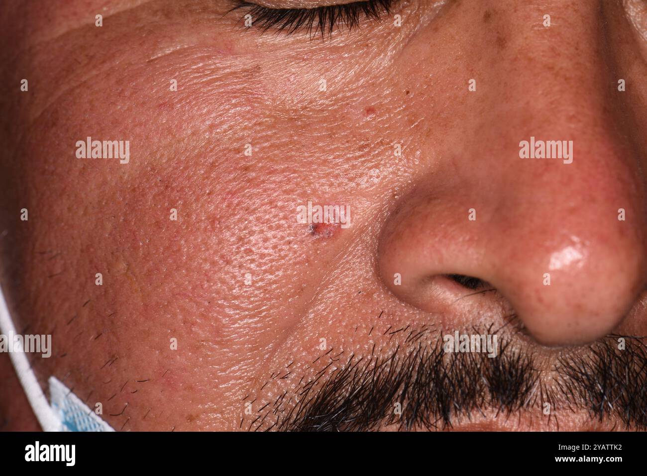 Basal cell carcinoma (BCC), or rodent ulcer, on a patient's skin. This ...
