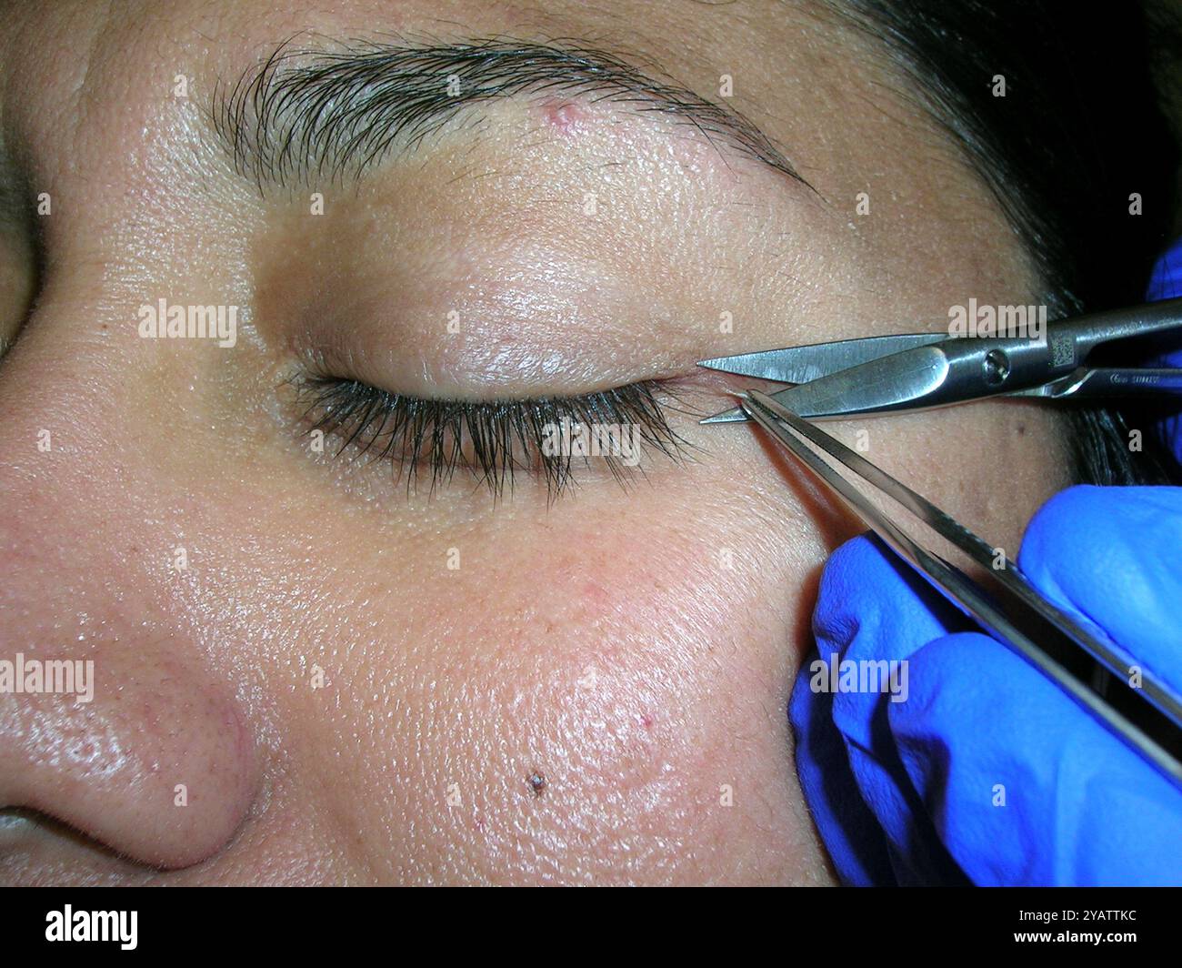 Hidrocystoma excision. Scissors being used for a snip removal of a ...