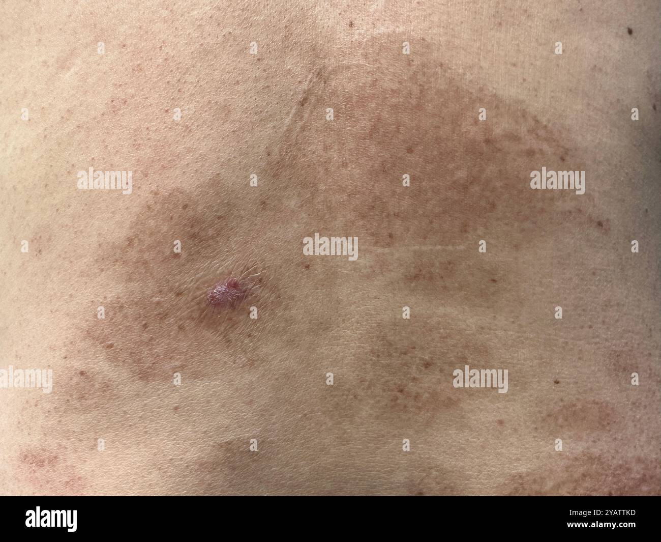 Psoriasis on a patient's back that is being treated with intralesional ...