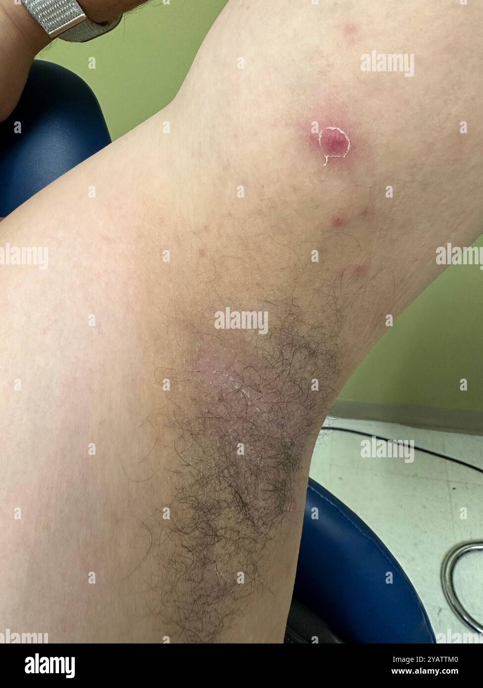 Folliculitis on a Hispanic male patient's arm. Folliculitis is an ...