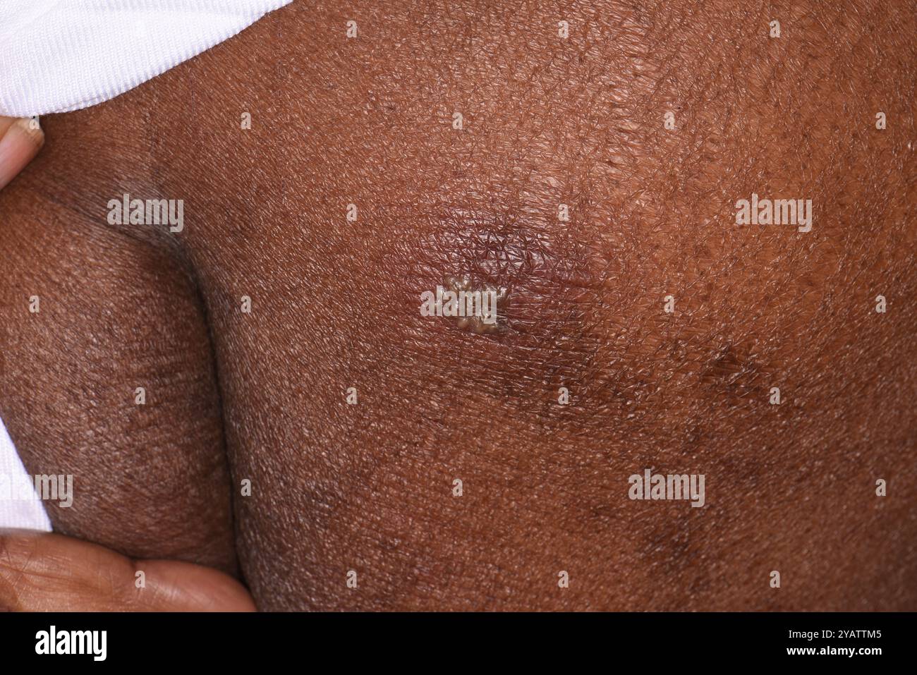 Blistering caused by herpes simplex virus (HSV) infection on the ...