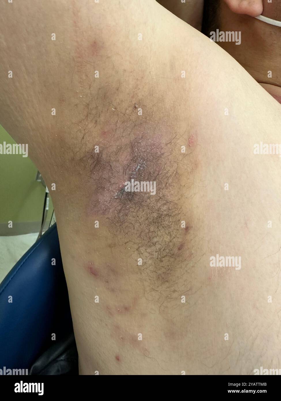 Folliculitis in a Hispanic male patient's armpit. Folliculitis is an ...