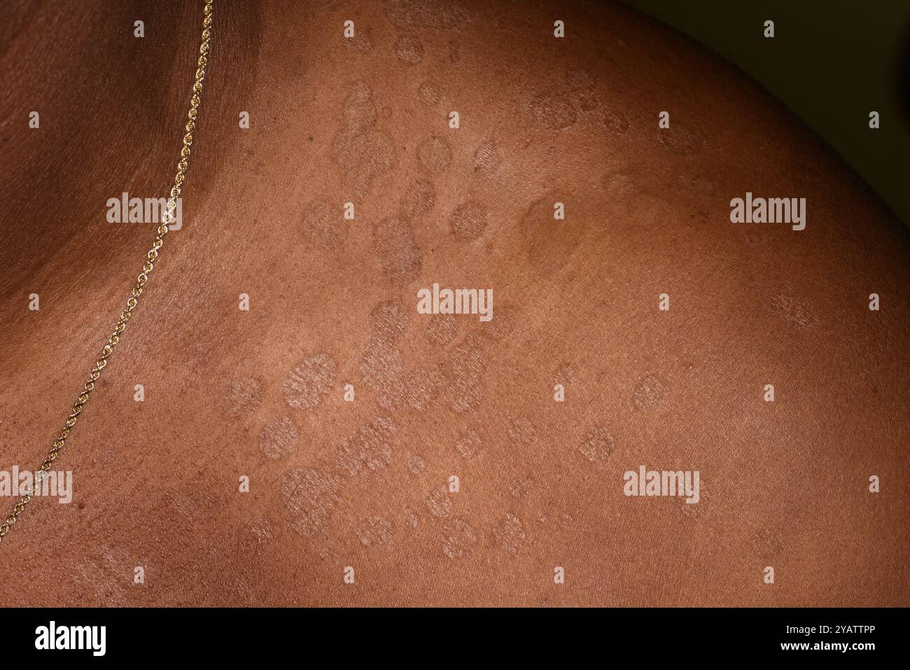 Lesions (light areas) on the shoulder of a patient with the fungal ...