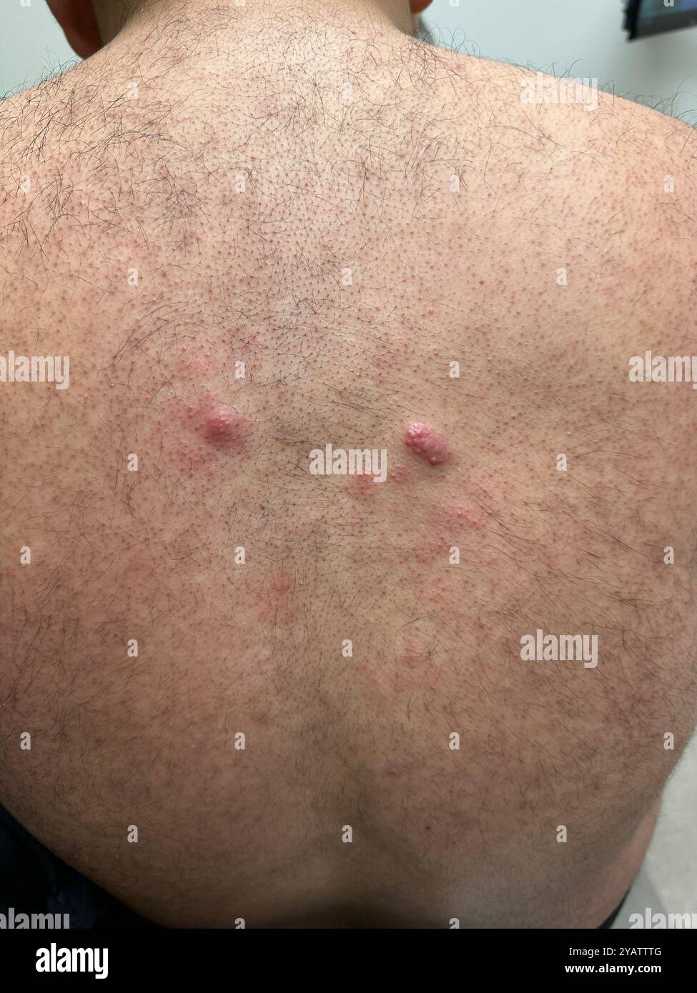 Lesions on the back of an 18 year old Hispanic male patient with ...