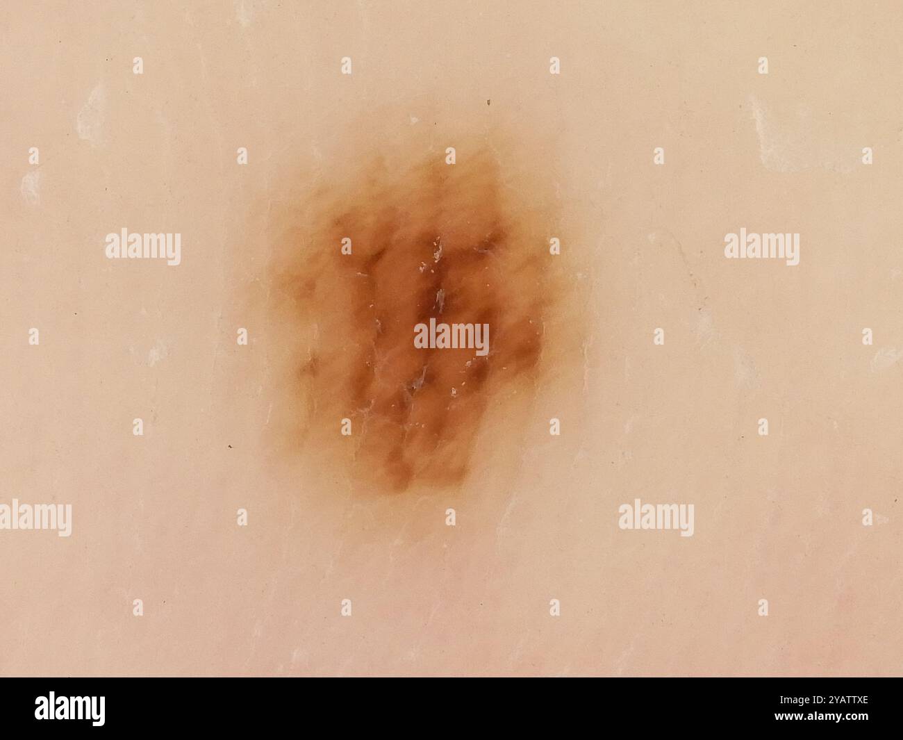 Dermatoscope image of a mole on the sole of the foot of a 35 year old ...