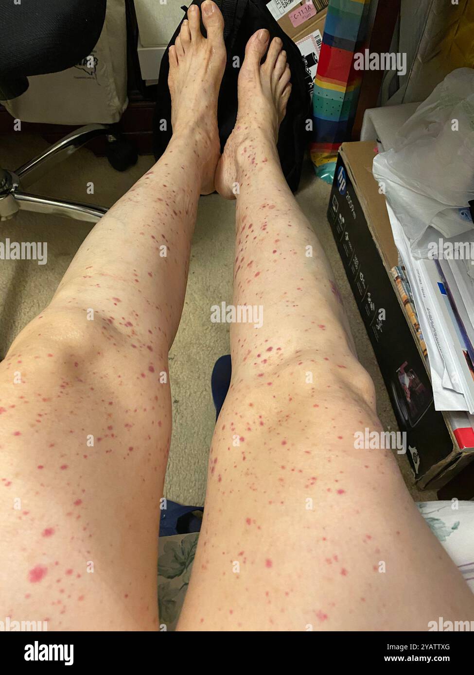 Legs of a Vietnamese female patient with leukocytoclastic vasculitis ...
